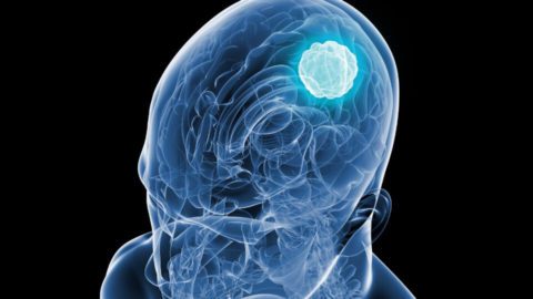 Immunotherapy for Glioblastoma - Glioblastoma Cancer Clinical Trial